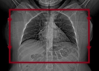 Toraks BT Nasıl Çekilir ? | Toraks BT Çekimi Nasıl Yapılır